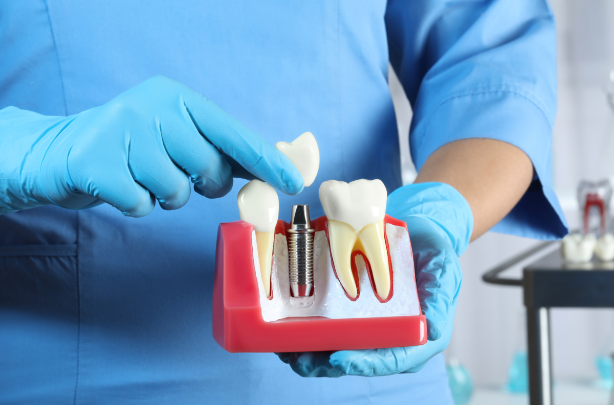 Custom Abutment Implant | Cost | Uptown Dental Lab