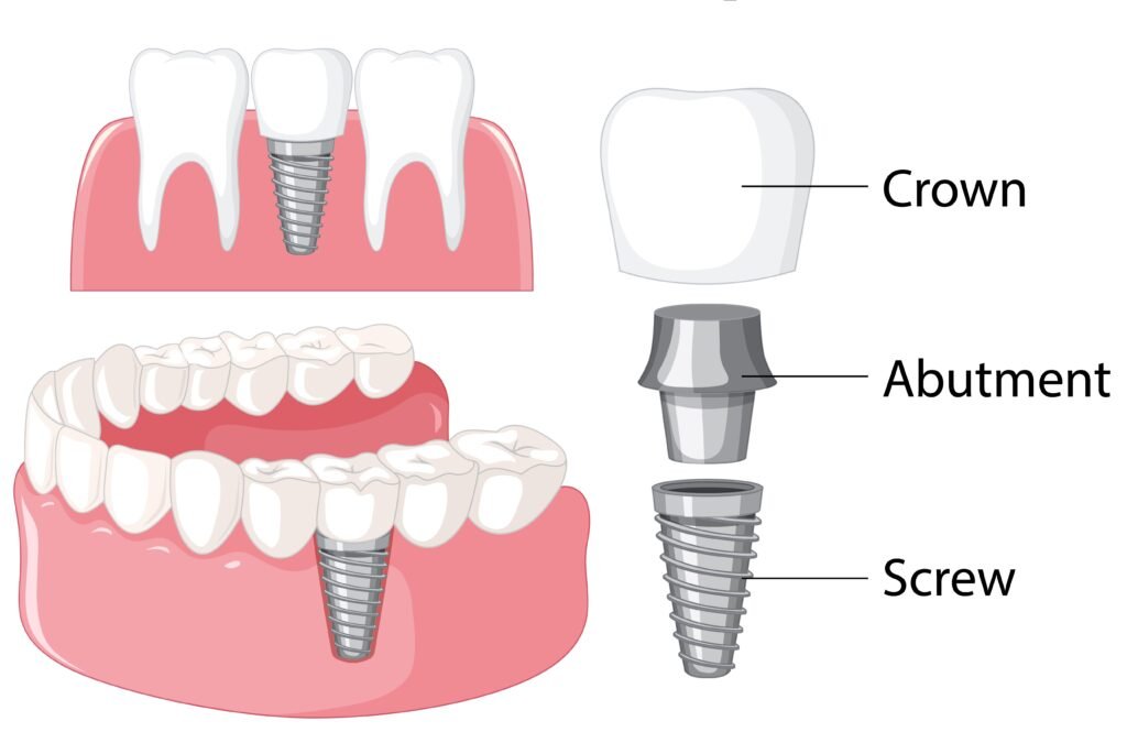 Difference between custom abutment and screw retained crown