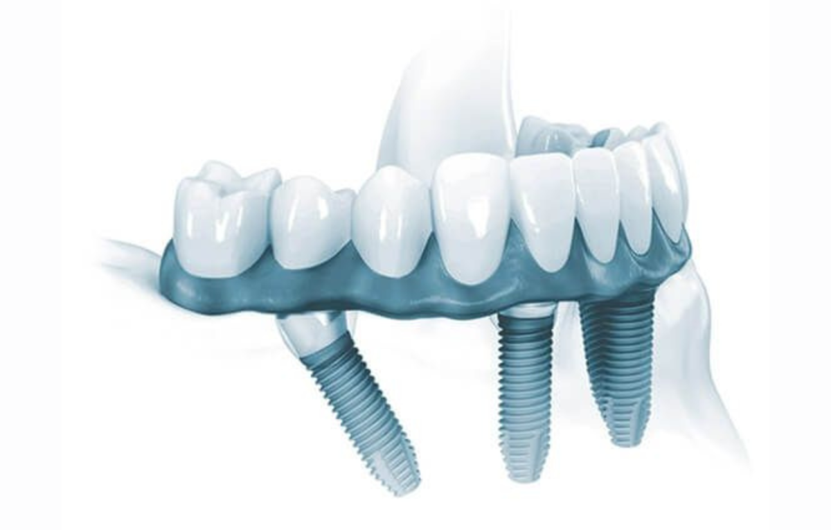 Zirconia vs PMMA vs Acrylic: Which All on 4 Material is better?